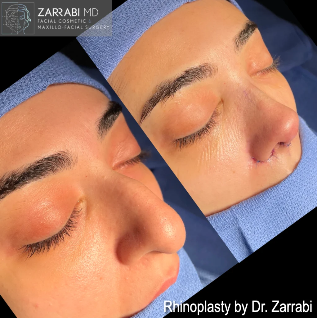 Ultrasonic (Piezo) Rhinoplasty | Dr. Shahrouz Zarrabi, MD